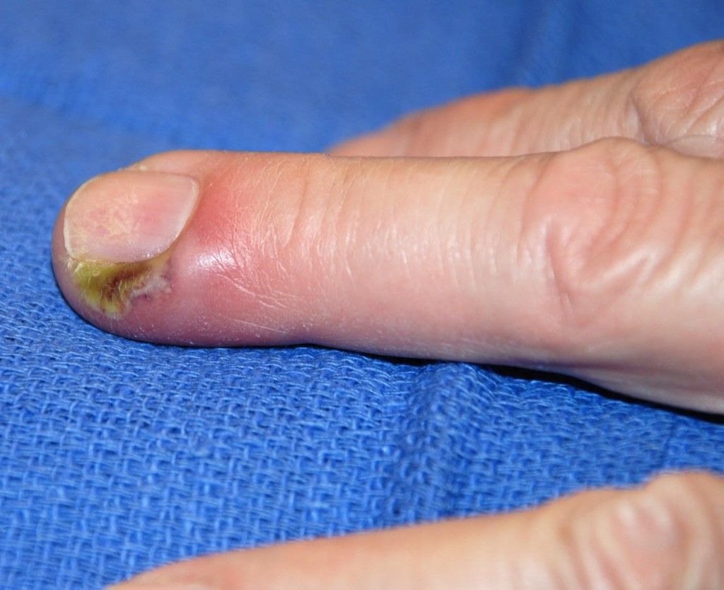 Паронихий: симптомы, причины, лечение